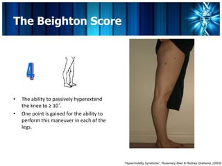 Ehlers-Danlos Syndrome & Hypermobility | PPTX