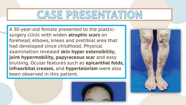 Ehlers danlos syndrome case.pptx