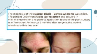 Ehlers danlos syndrome case.pptx