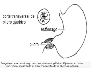 Estenosis Hipertrofica Del Piloro | PPTX
