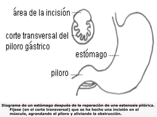 Estenosis Hipertrofica Del Piloro | PPTX