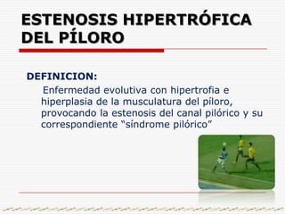 Estenosis Hipertrofica Del Piloro | PPTX