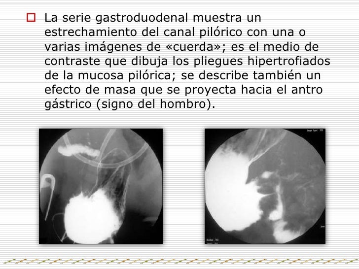 Estenosis Hipertrofica Del Piloro