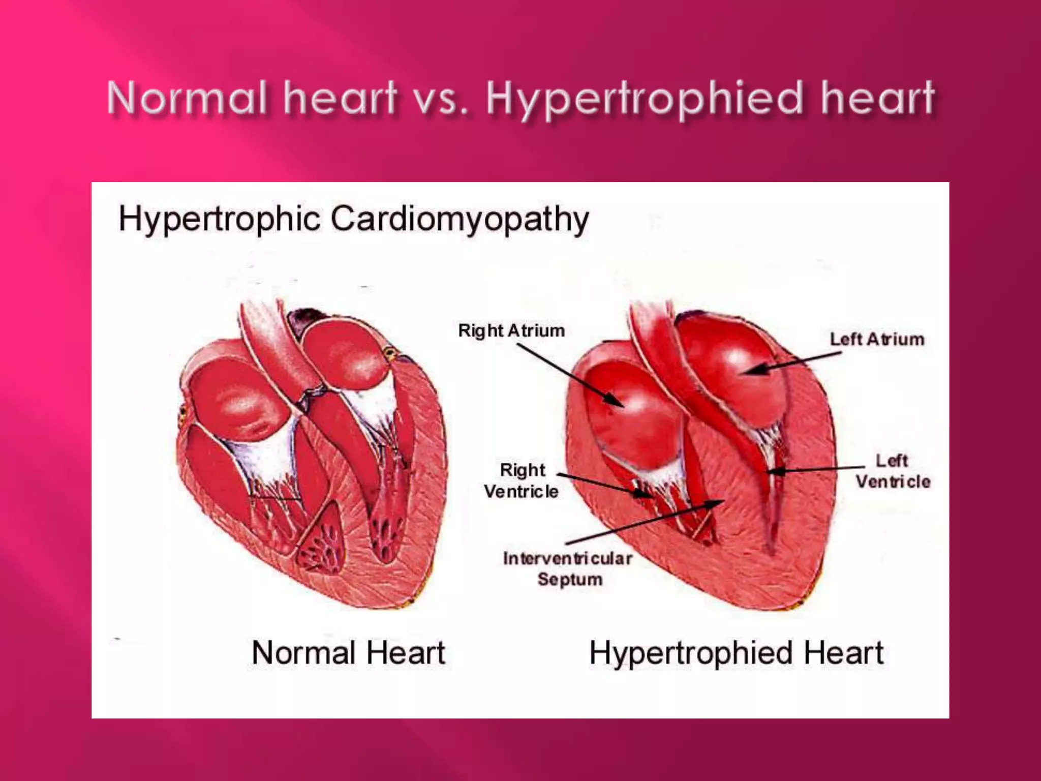 Student Work Hypertrophic Cardiomyopathy | PPTX