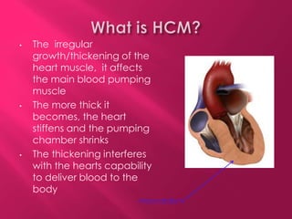 Student Work Hypertrophic Cardiomyopathy | PPTX