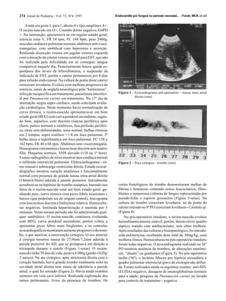 EI por fungos no período neonatal | PDF
