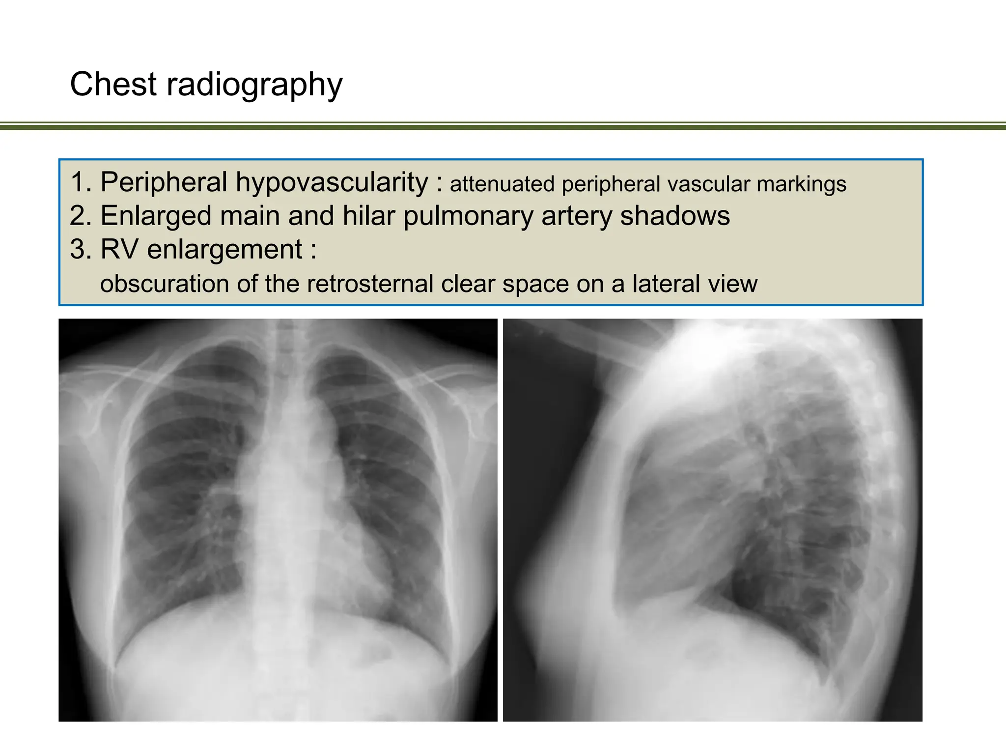 Eisenmenger syndrome - physiology and evaulation of eisenmenger’s ...