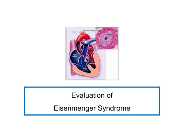 Eisenmenger syndrome - physiology and evaulation of eisenmenger’s ...