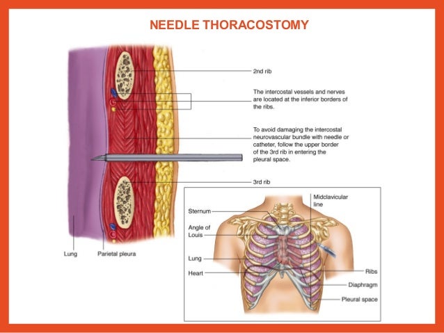 Resuscitation and thoracic trauma