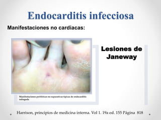 Endocarditis infecciosa y pericarditis | PPTX