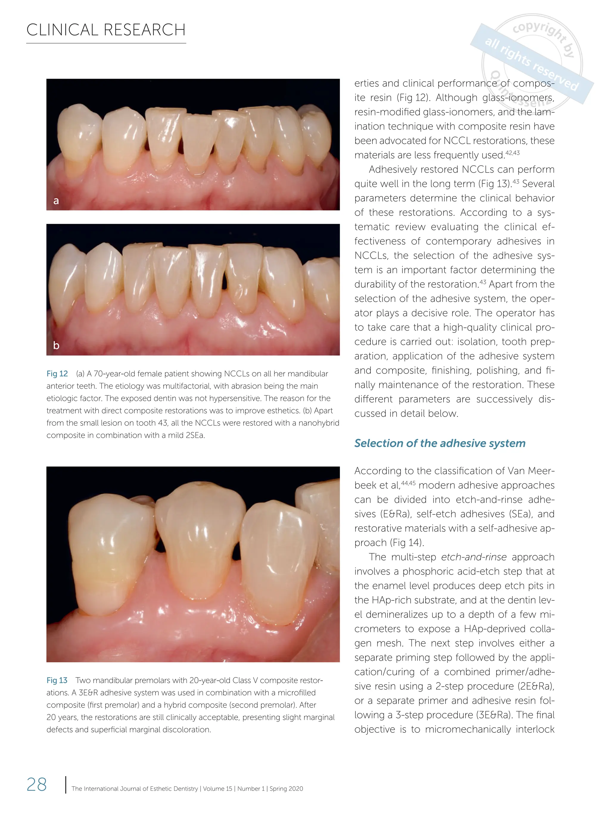 lesiones cervicales no cariosas. Tratamienyo | PDF