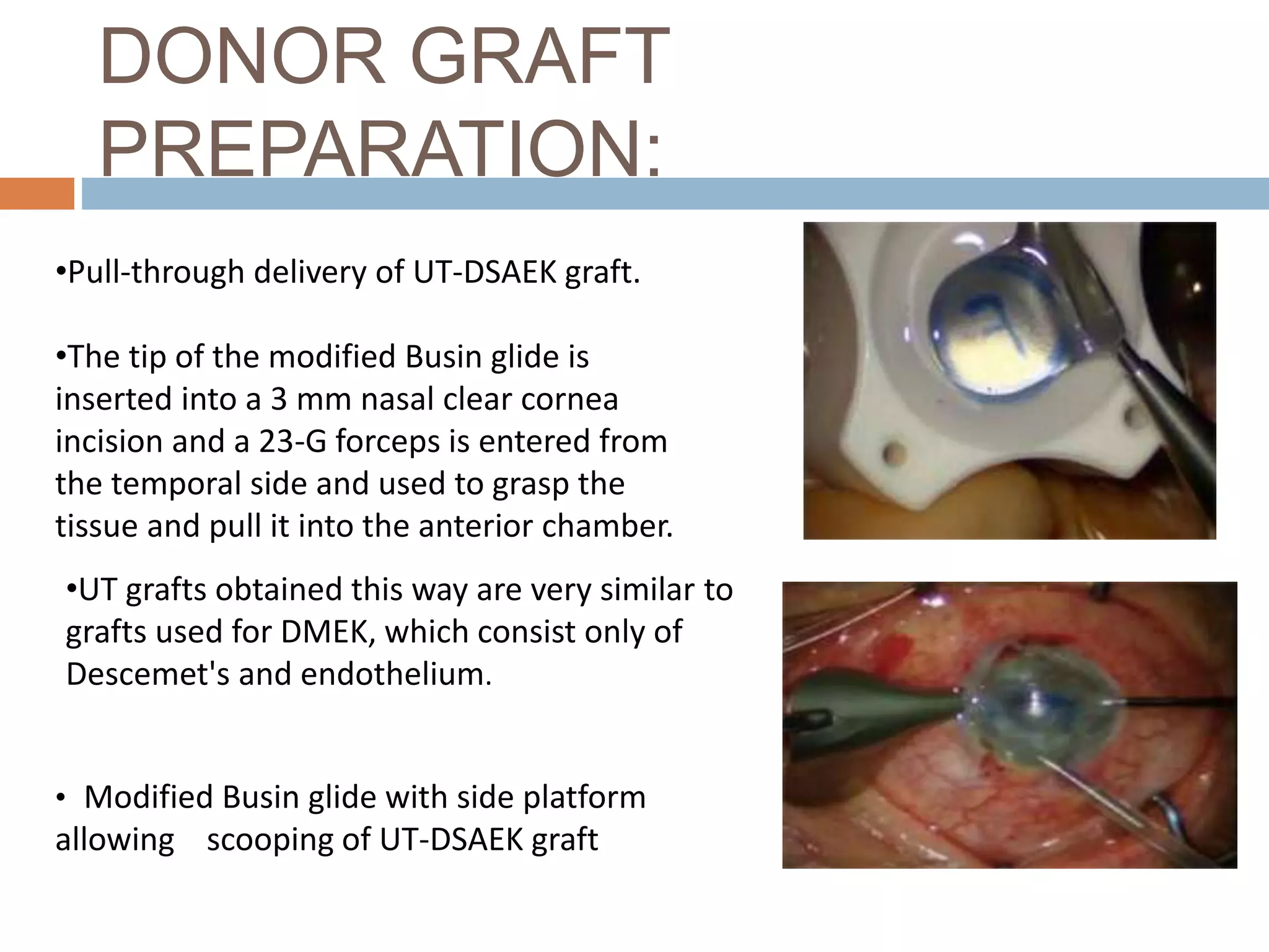 Endothelial keratoplasty | PPTX