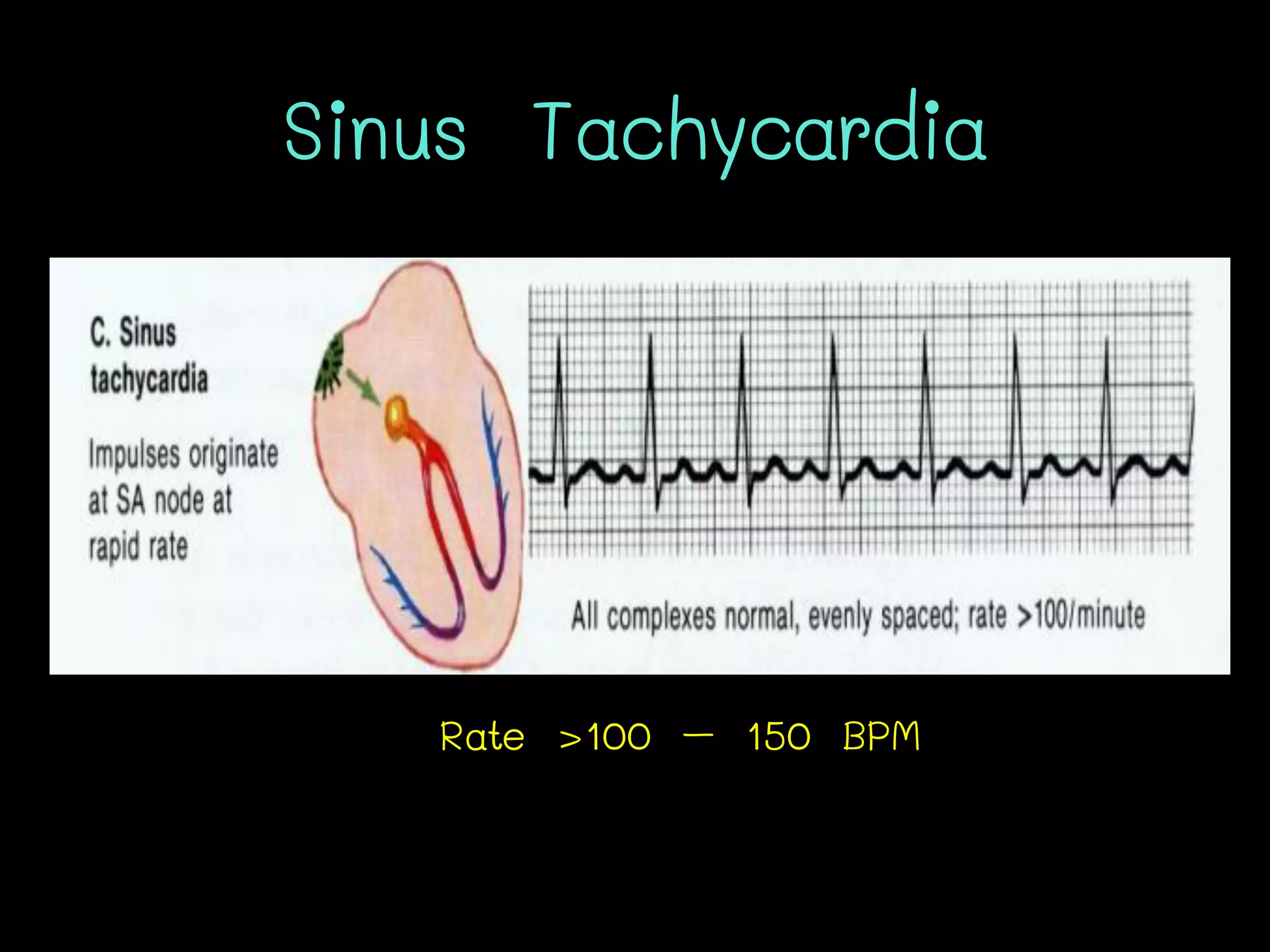 การอ่านค่า Ekg | PDF