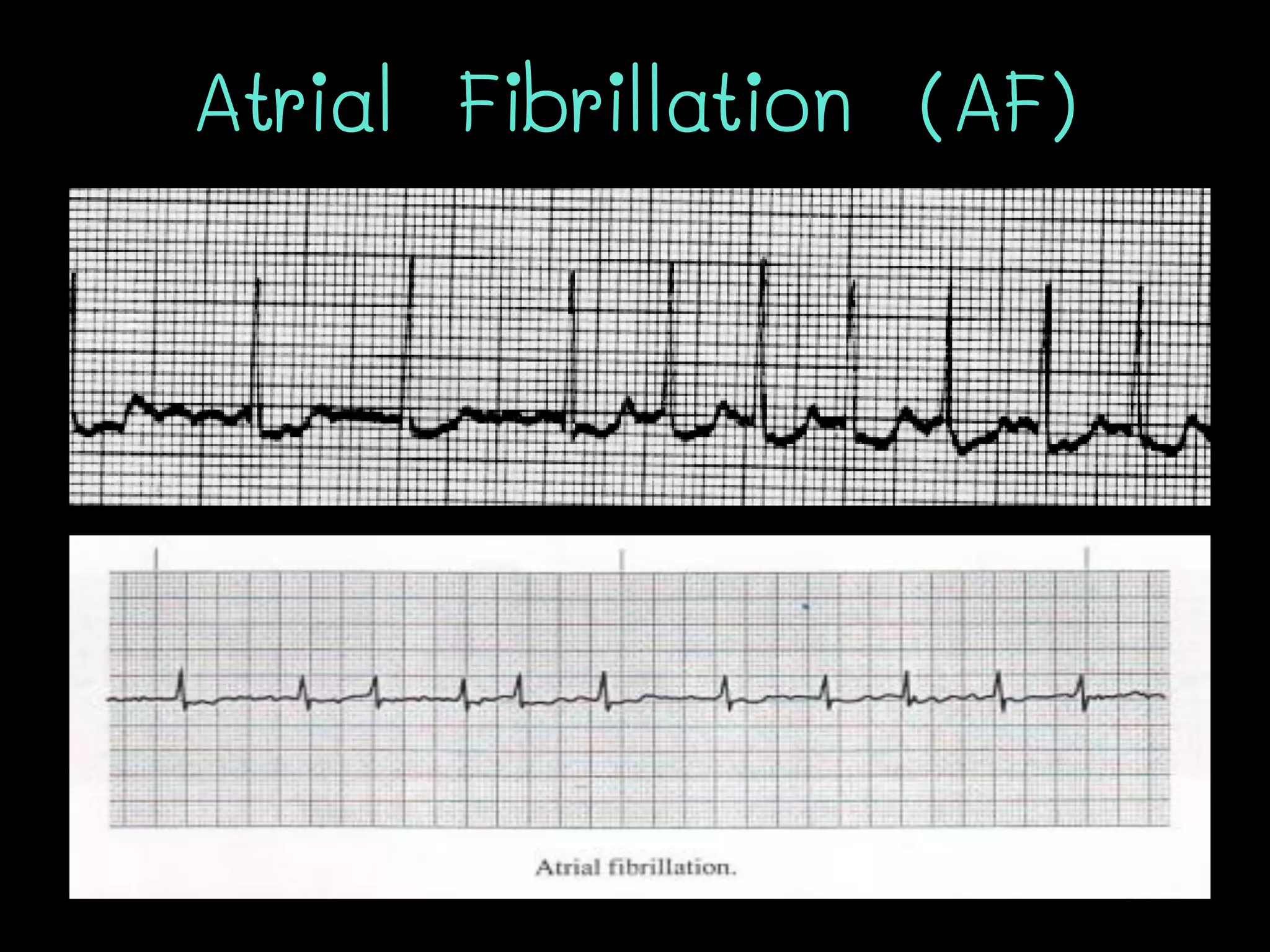การอ่านค่า Ekg | PDF