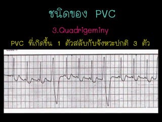 การอ่านค่า Ekg | PDF