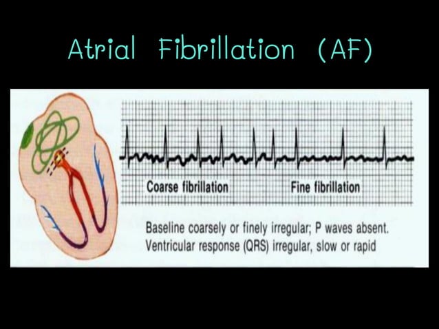 การอ่านค่า Ekg | PPT
