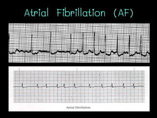 การอ่านค่า Ekg | PPT