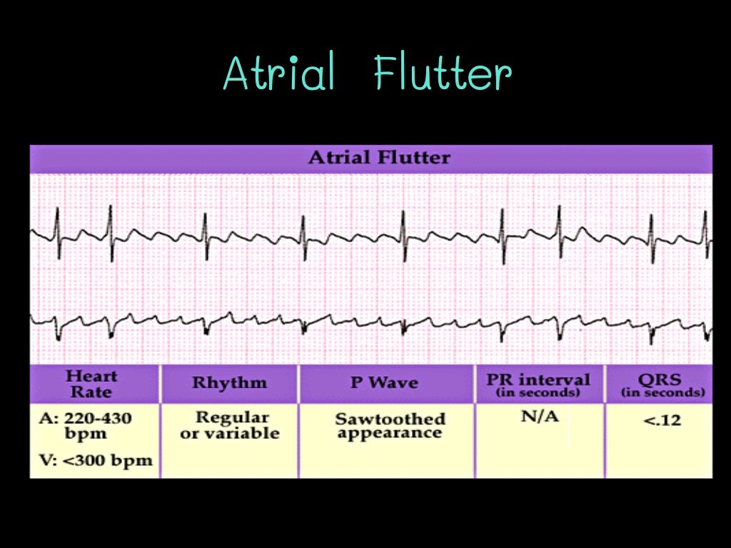 การอ่านค่า Ekg