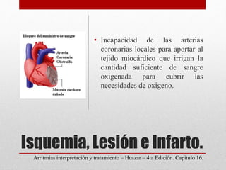 Isquemia Electrocardiograma | PPTX