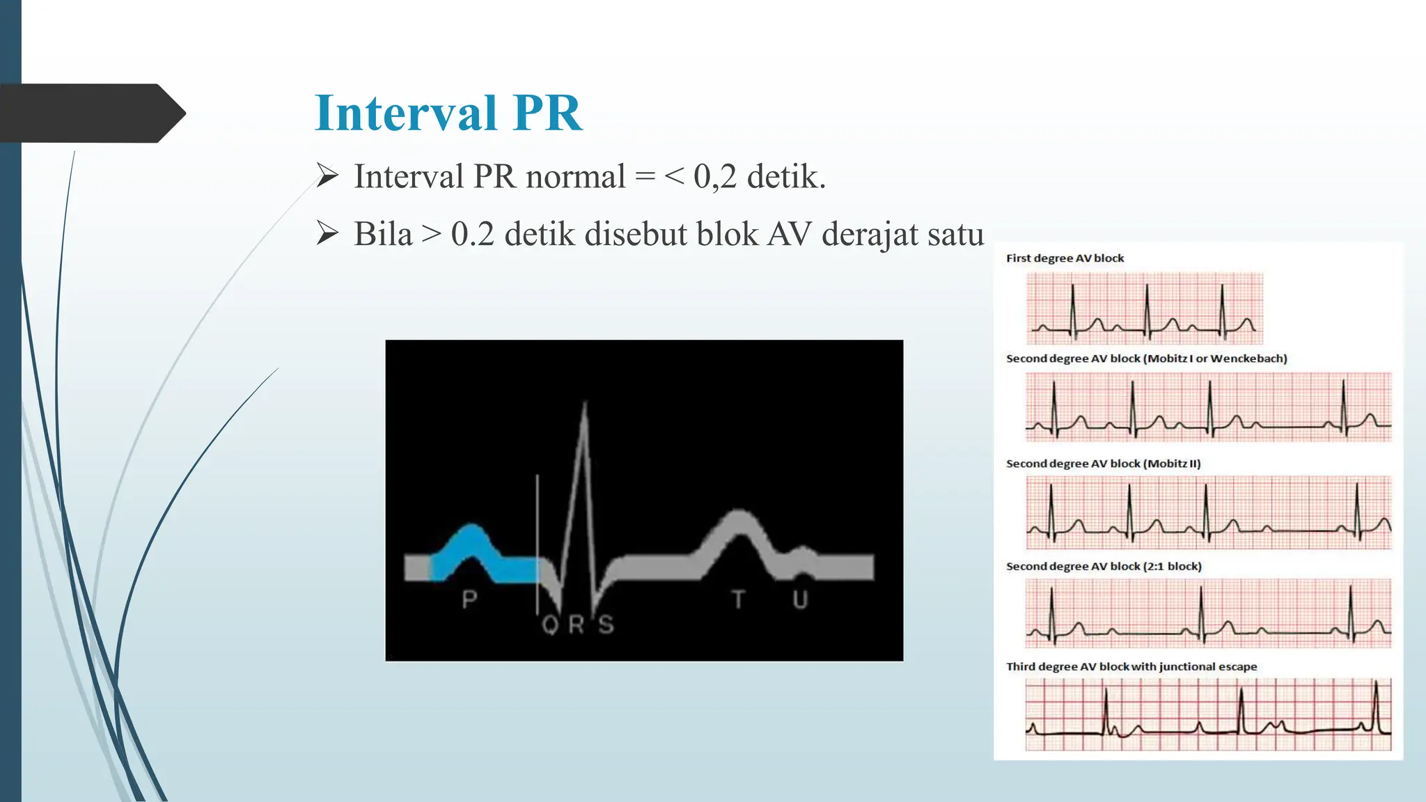 Cara membaca EKG dengan baik dan benar, untuk tenaga kesehatan | PPT