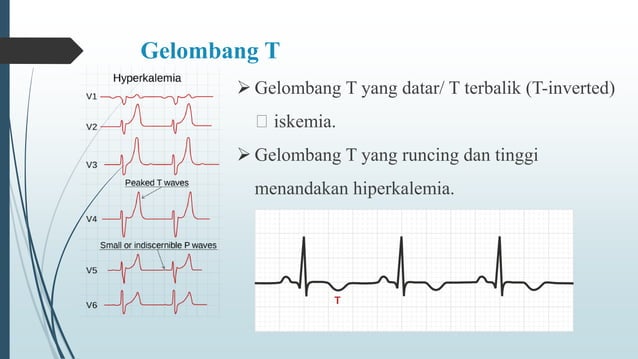 Cara membaca EKG dengan baik dan benar, untuk tenaga kesehatan | PPT
