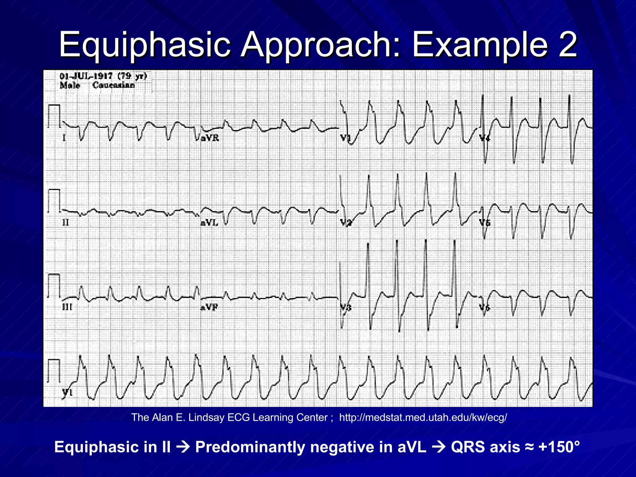 Ekg Basics Long | PPT