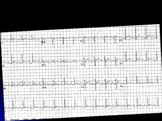 EKG Module | PPT