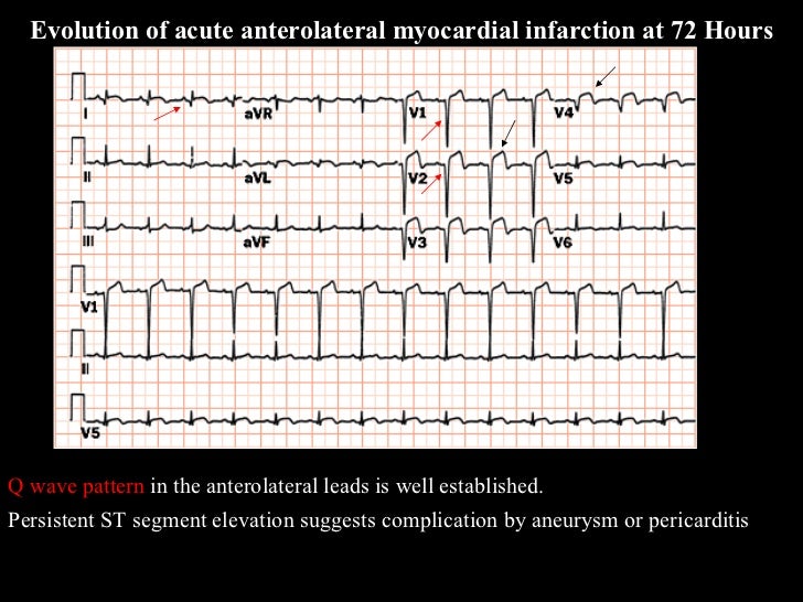 Ekg Tutorial