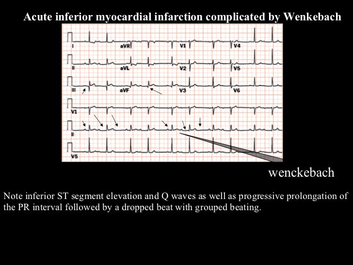 Ekg Tutorial