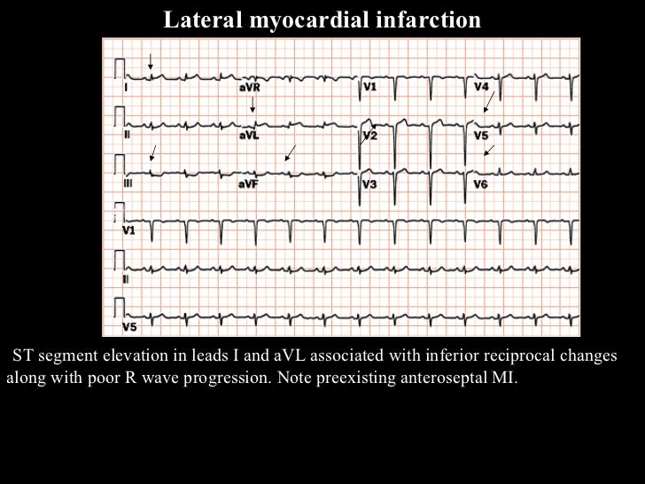 Ekg Tutorial