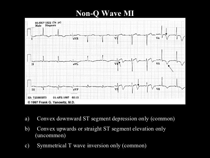 Ekg Tutorial