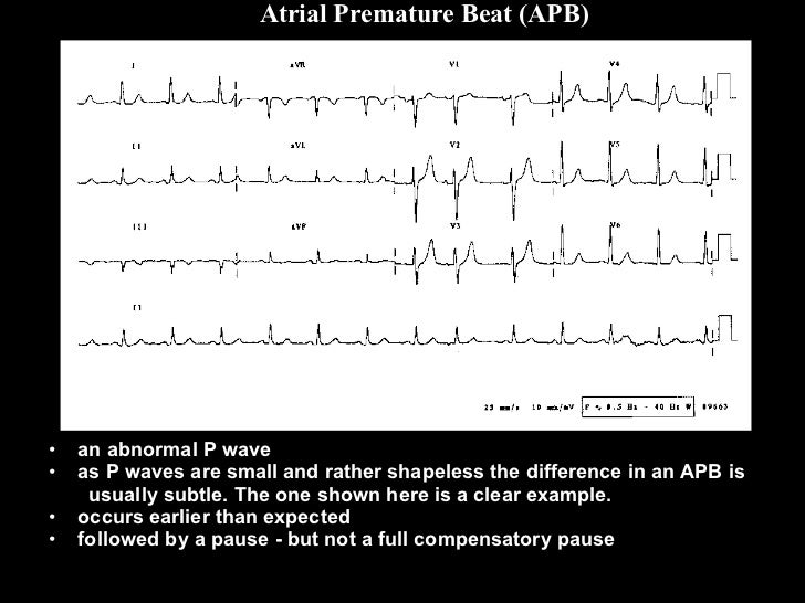 Ekg Tutorial
