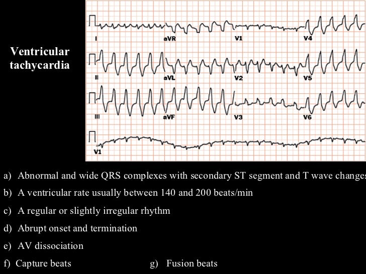 Ekg Tutorial