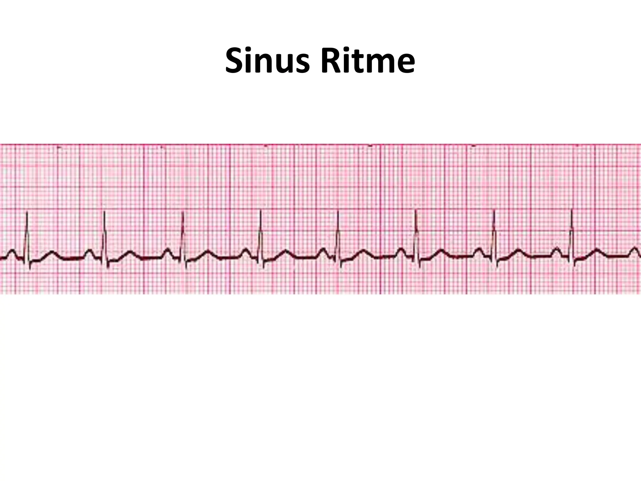 Mengenal aritmia yang mengancam atau letal aritmia | PPT