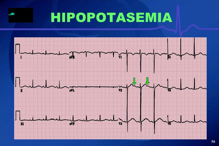 Ekg3 Normal, Hipertrofias Y Urgencias
