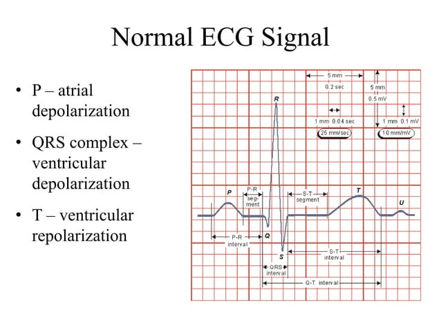 EKG analysis.ppt
