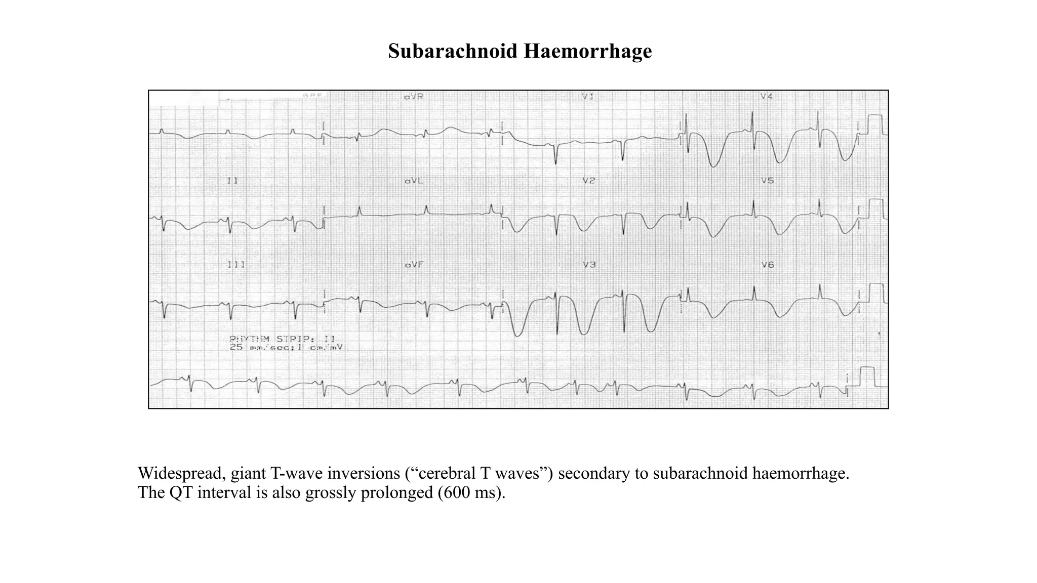 ekg changes in electrolyte abnormalities.pptx