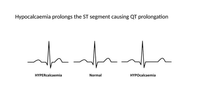 ekg changes in electrolyte abnormalities.pptx