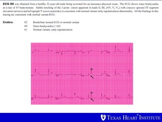 EKG for cardiology Board review | PPTX