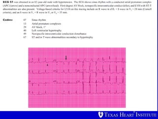 EKG for cardiology Board review | PPTX