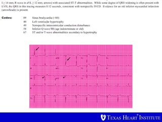 EKG for cardiology Board review | PPTX