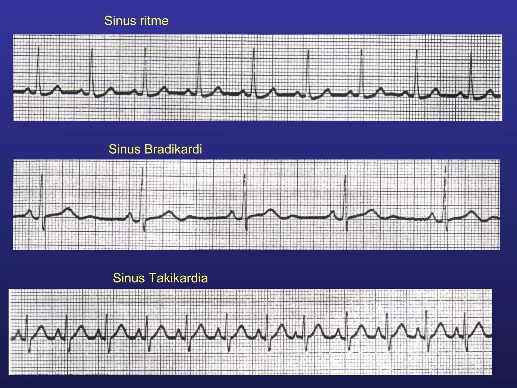 Ekg dasar | PPT