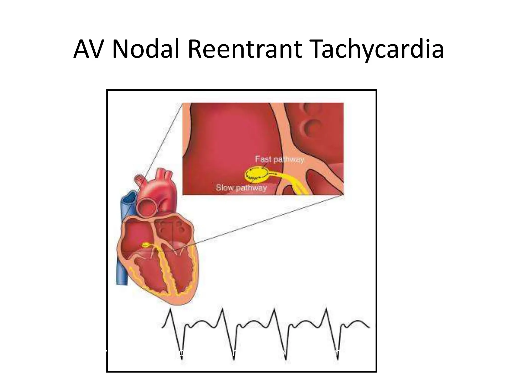 EKG dasar, aritmia SVT, VT, AV block.ppt