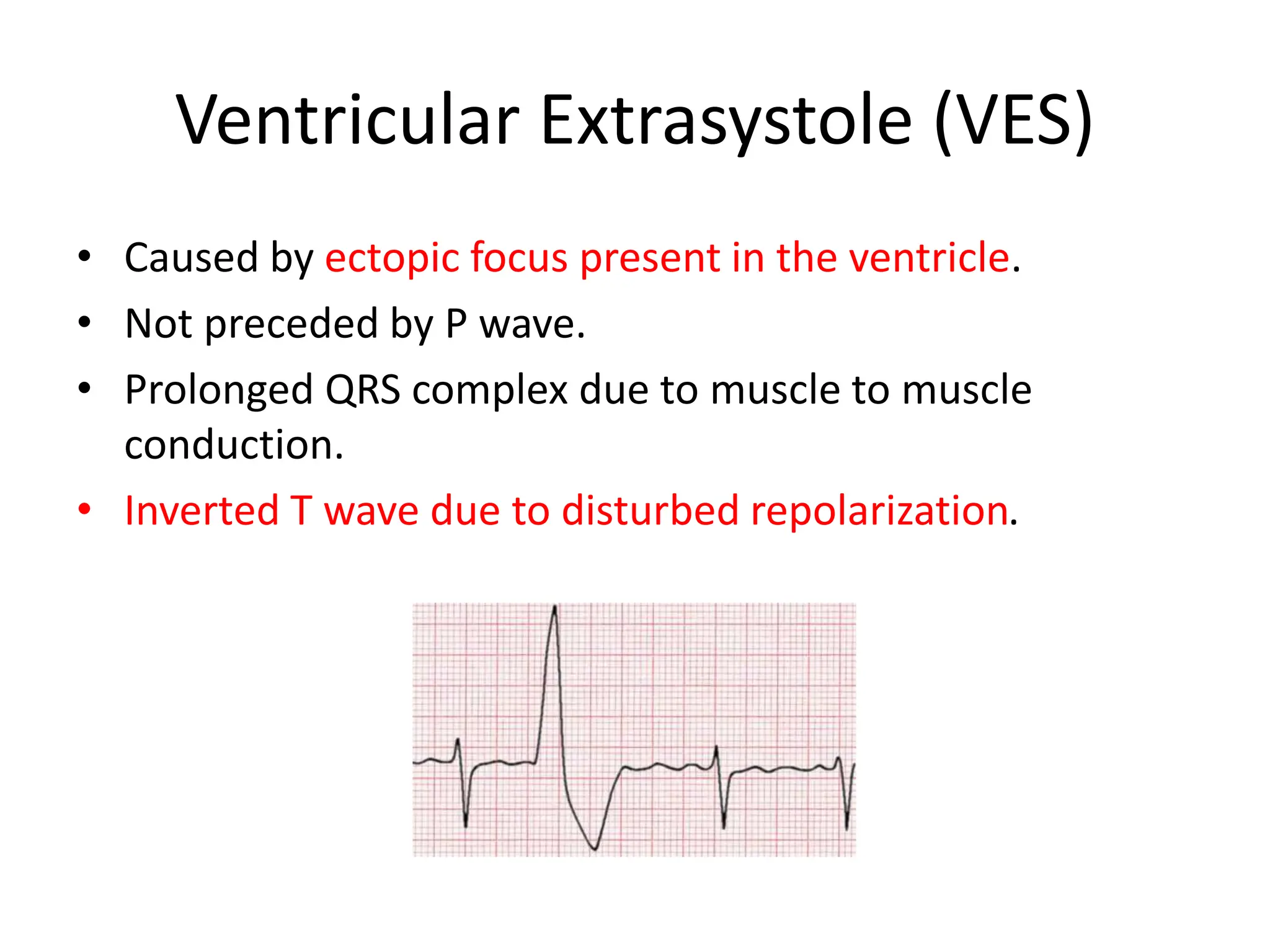 EKG dasar, aritmia SVT, VT, AV block.ppt