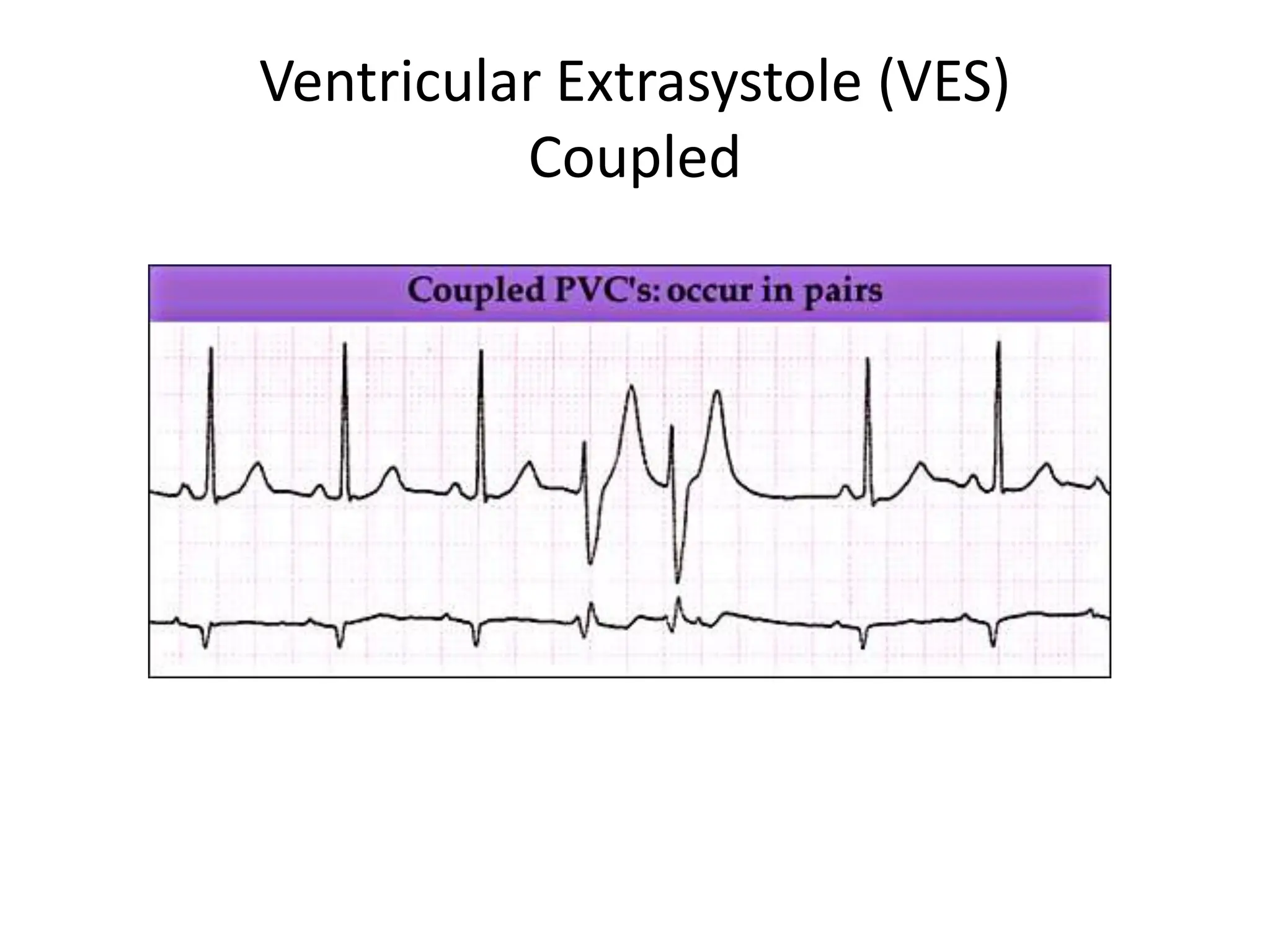 EKG dasar, aritmia SVT, VT, AV block.ppt