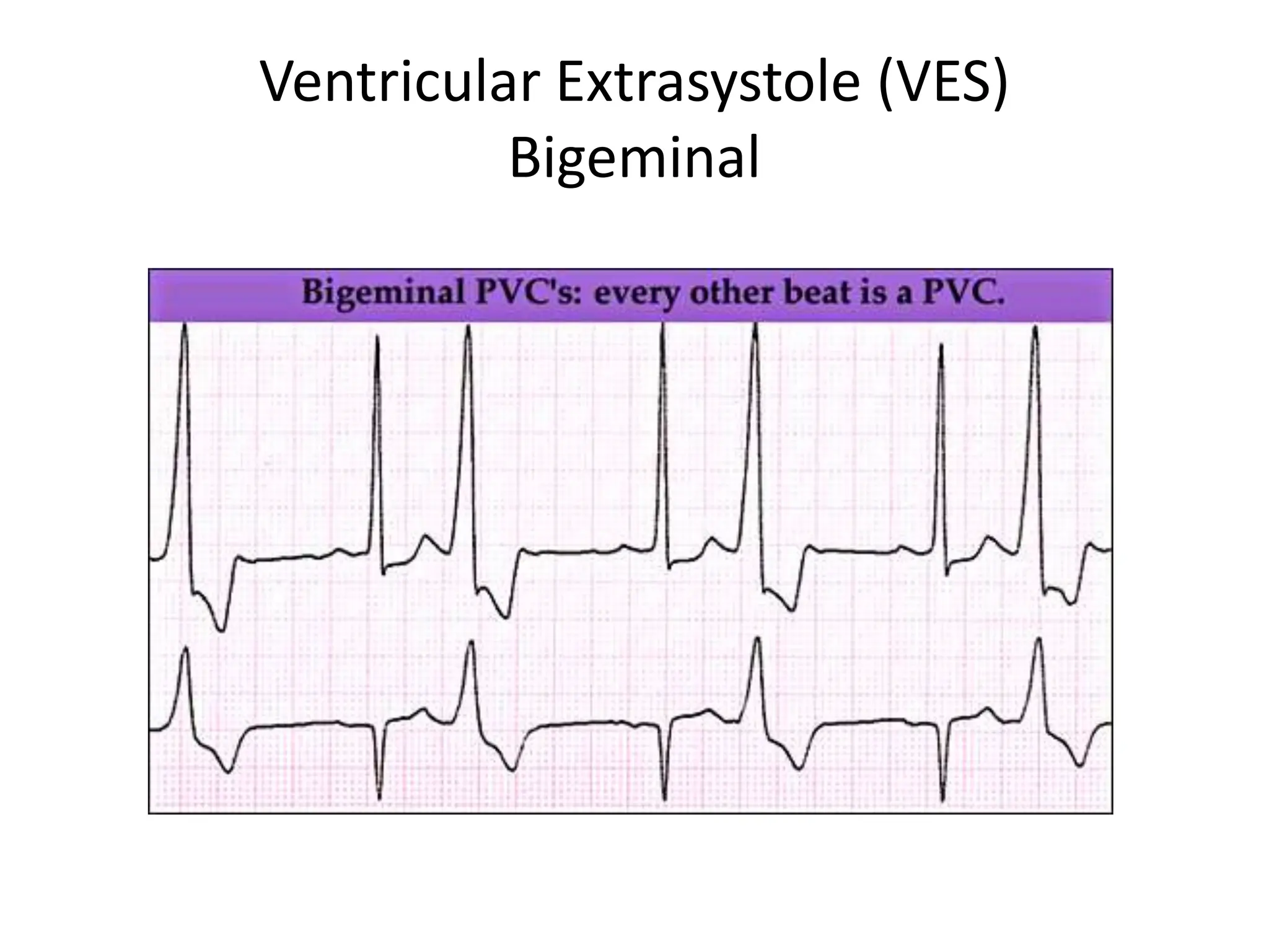EKG dasar, aritmia SVT, VT, AV block.ppt