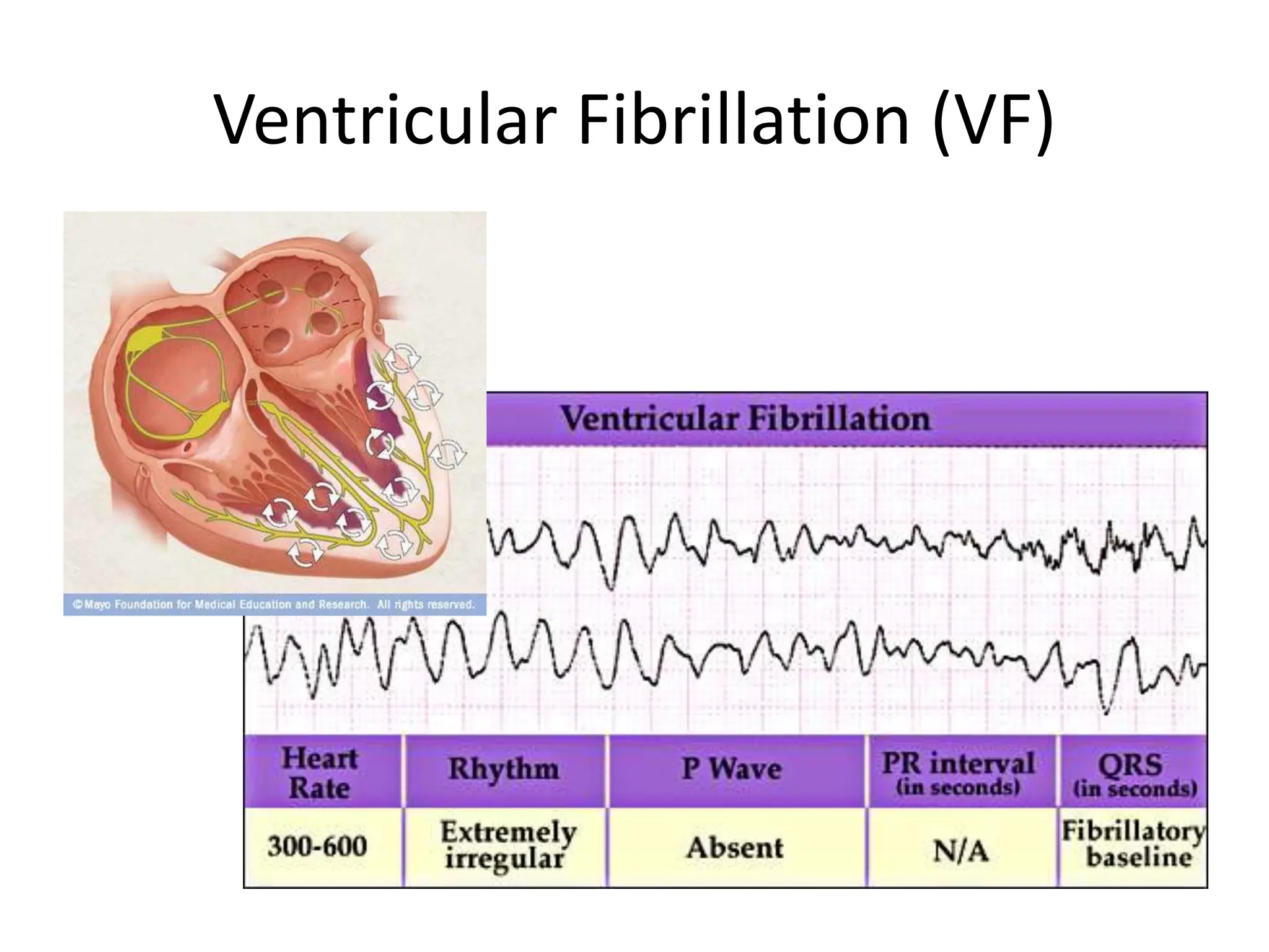 EKG dasar, aritmia SVT, VT, AV block.ppt