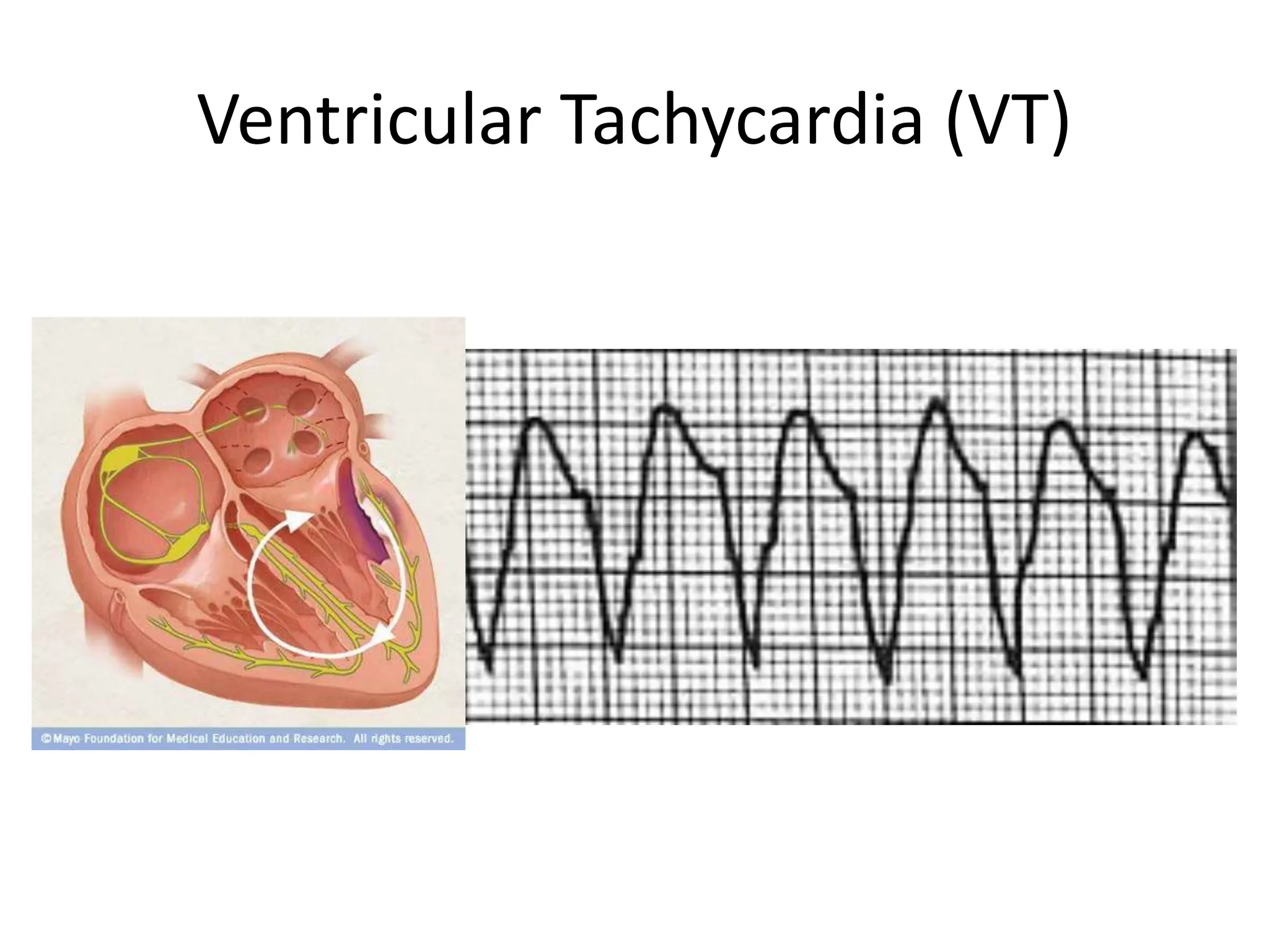 EKG dasar, aritmia SVT, VT, AV block.ppt
