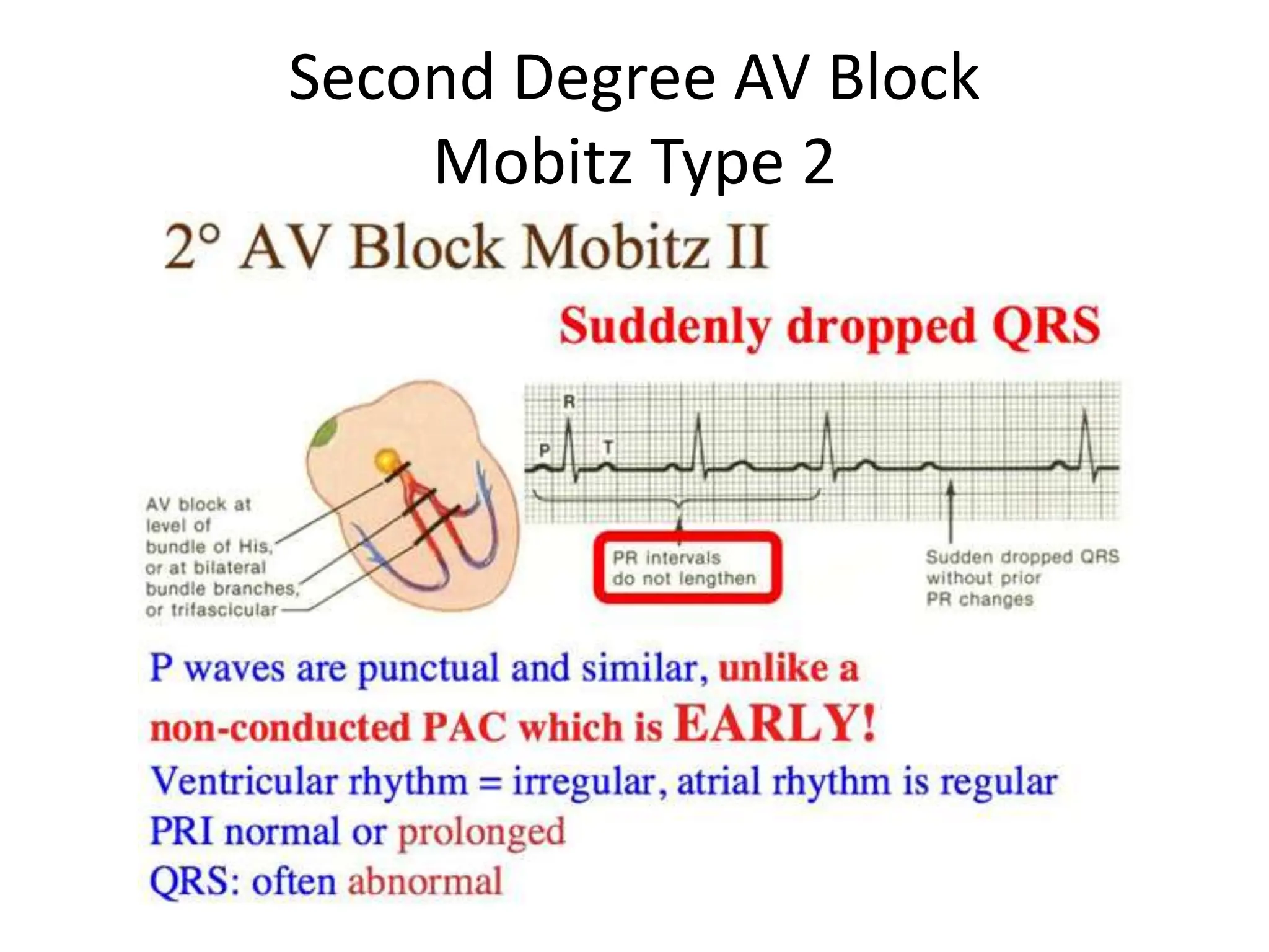 EKG dasar, aritmia SVT, VT, AV block.ppt
