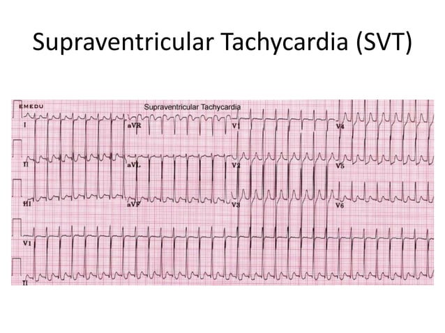EKG dasar, aritmia SVT, VT, AV block.ppt